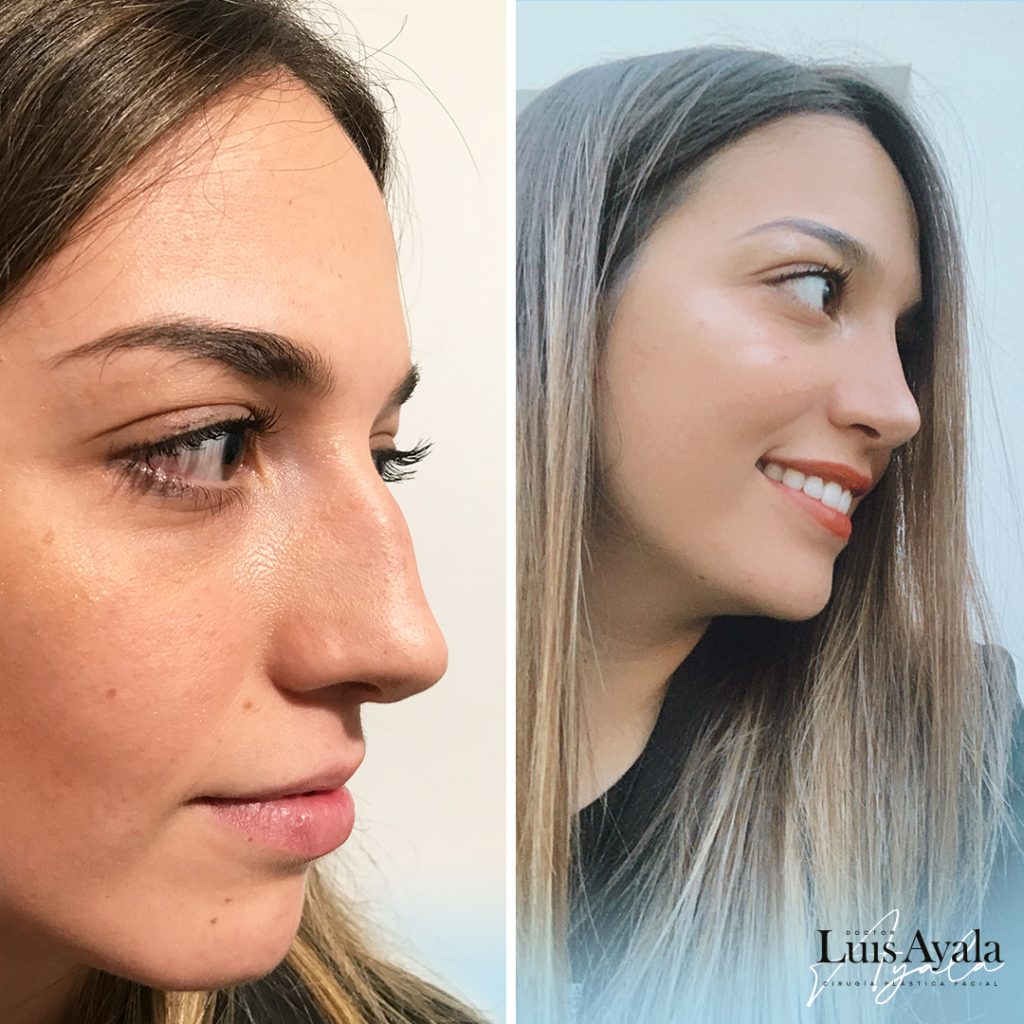 Rinoplastia Ultrasónica - Dr. Luis Ayala